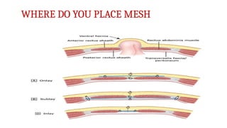 abdominal wall component separation.pptx