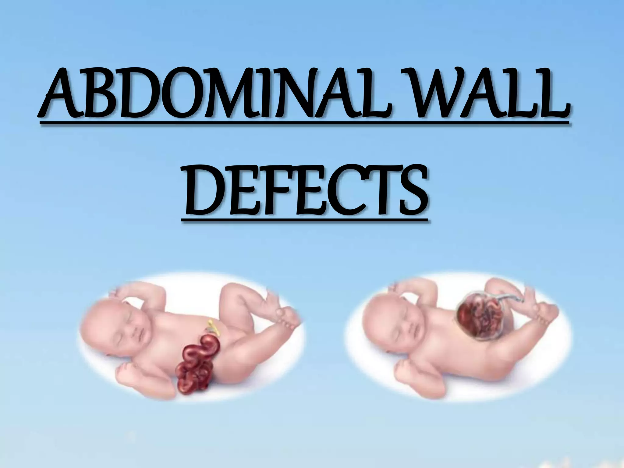 Abdominal wall defect | PPTX