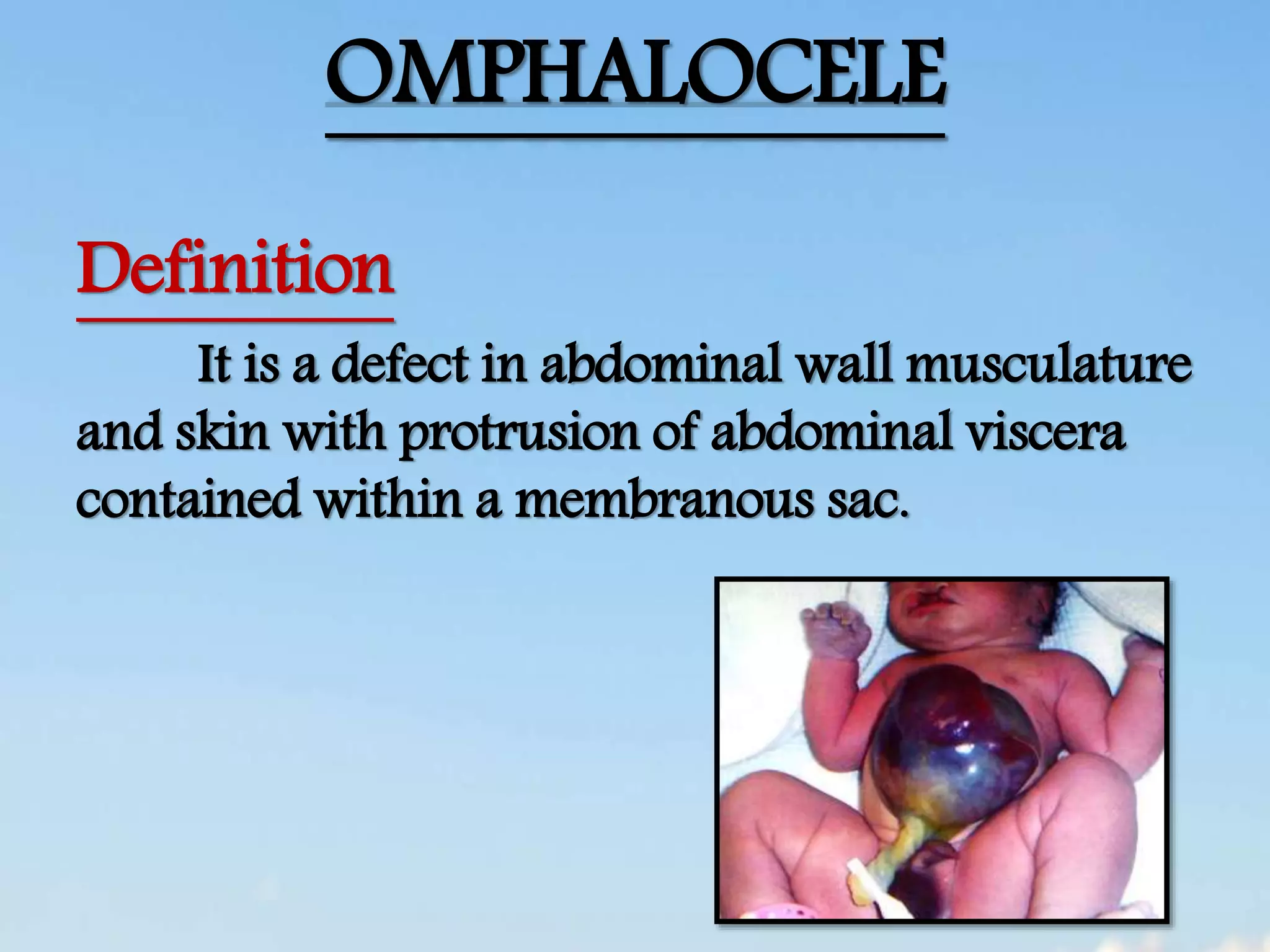 Abdominal Wall Defect Pptx
