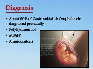 Abdominal wall defect | PPTX