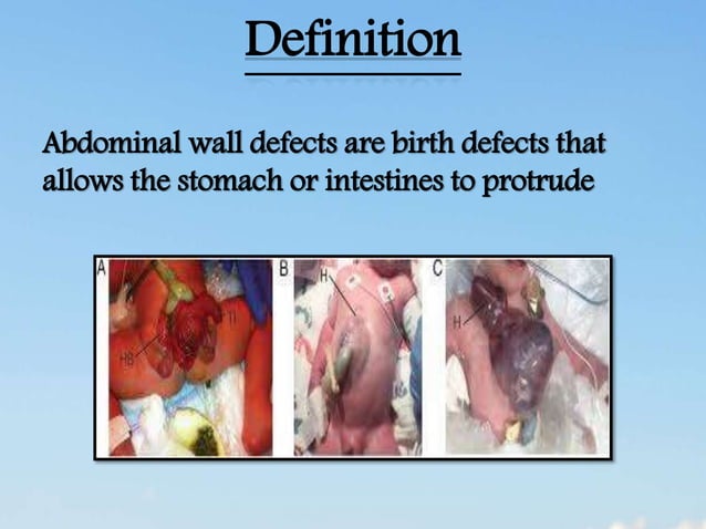 Abdominal wall defect | PPTX