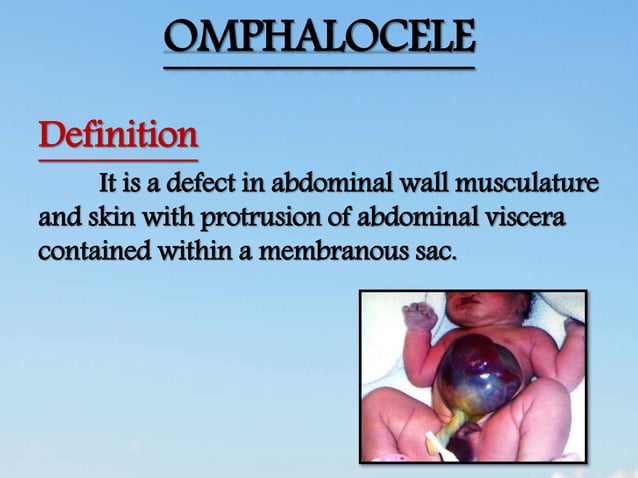 Abdominal wall defect | PPTX