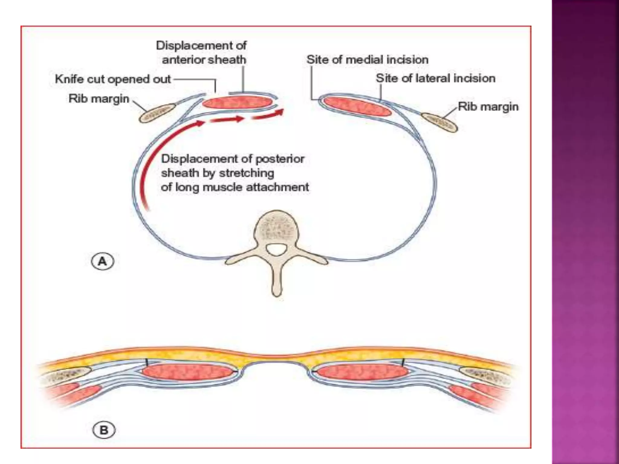 Abdominal wall defect reconstruction | PPTX