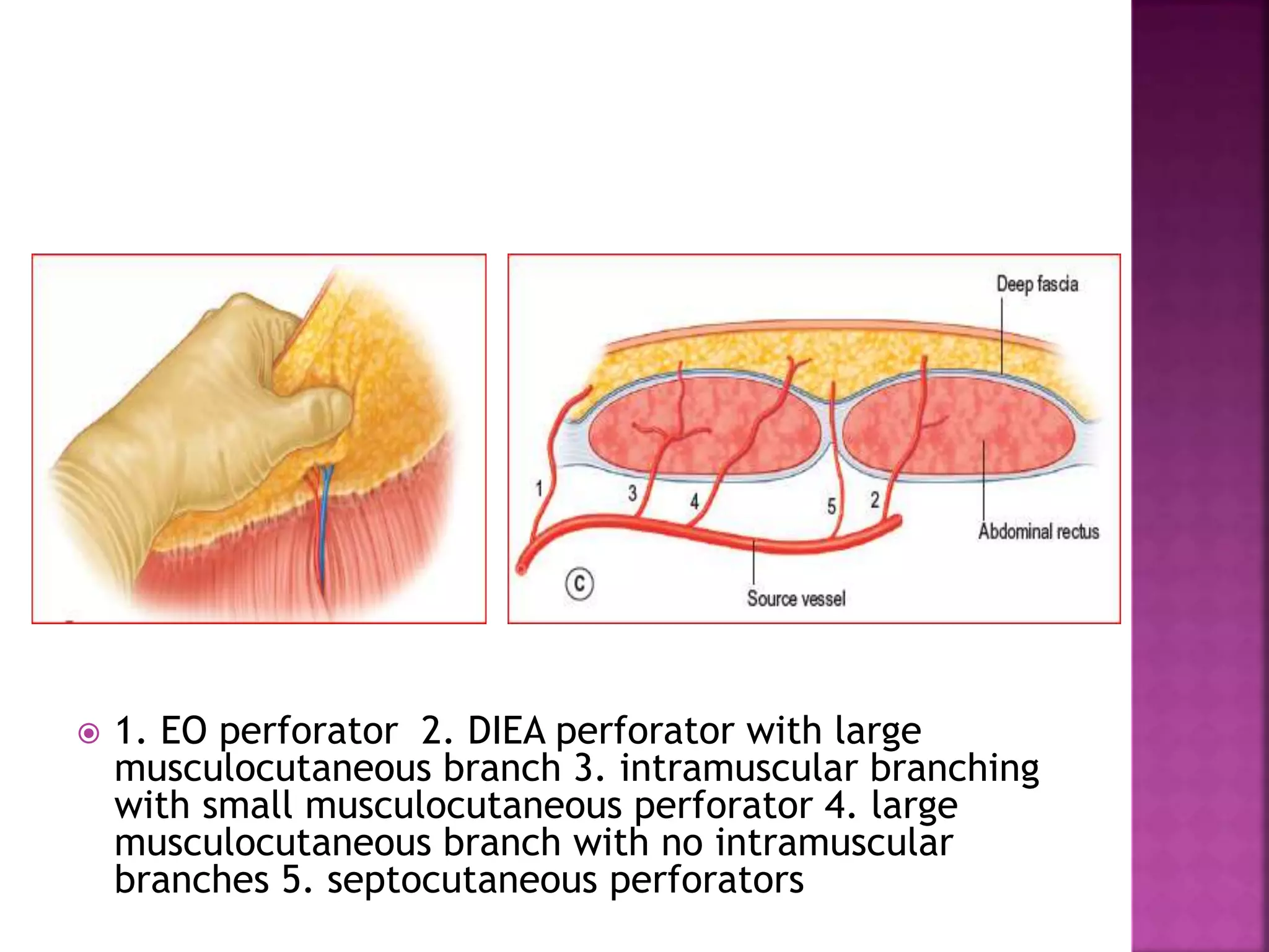 Abdominal wall defect reconstruction | PPTX