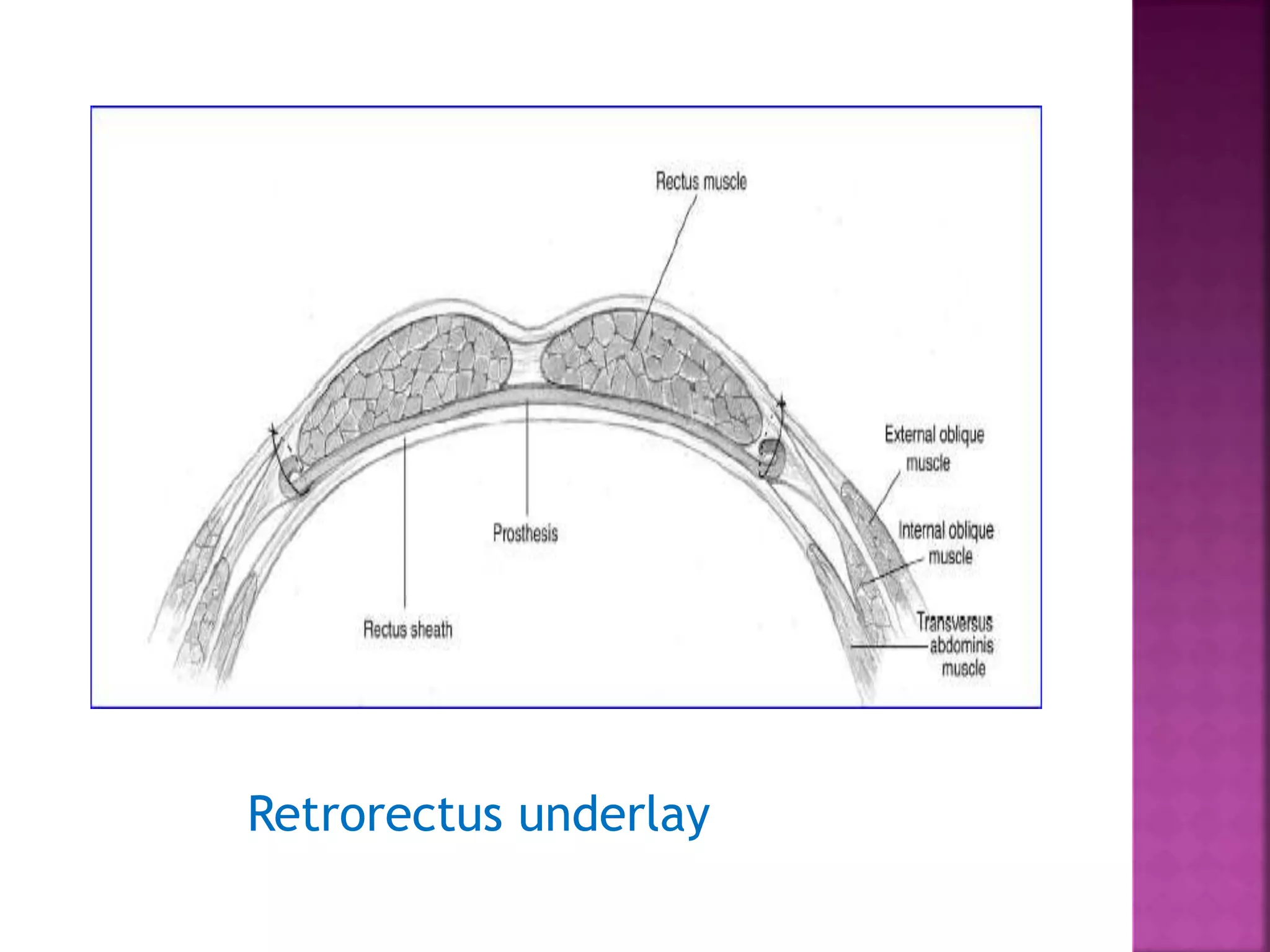 Abdominal wall defect reconstruction | PPTX