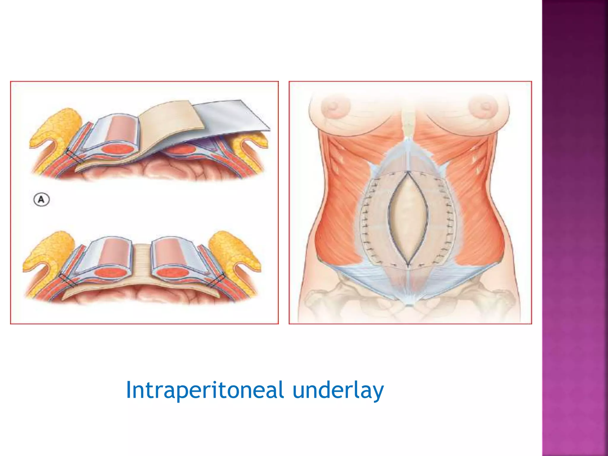 Abdominal wall defect reconstruction | PPTX