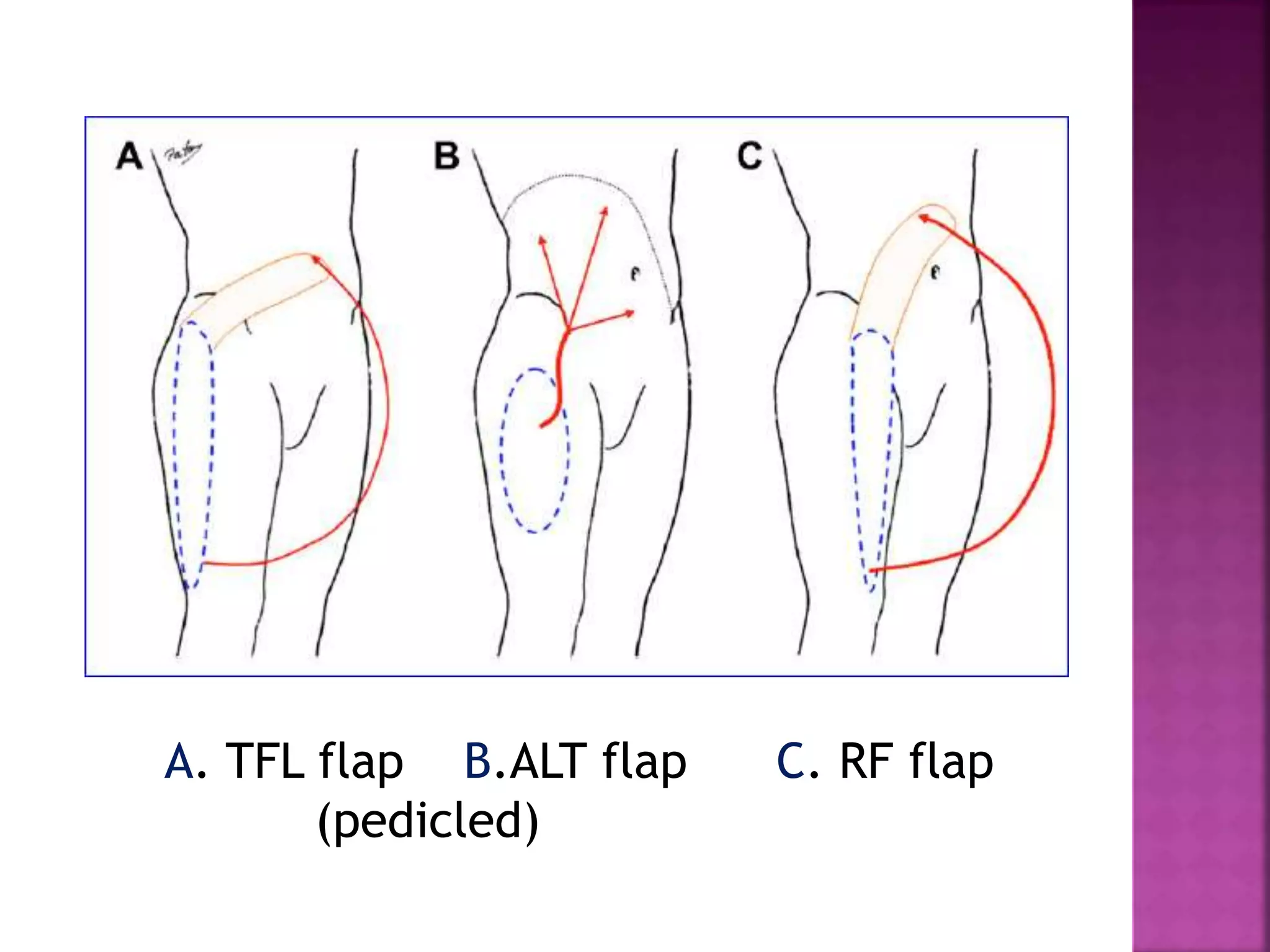Abdominal Wall Defect Reconstruction Pptx 4394
