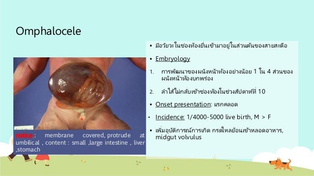 Abdominal wall defects