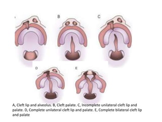 ABDOMINAL WALL DEFECTS.pptx