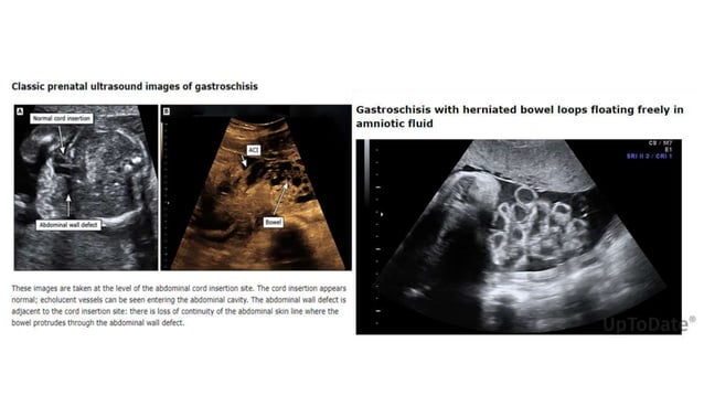 ABDOMINAL WALL DEFECTS in neonate and older childrenx | PPTX ...
