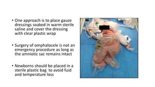 ABDOMINAL WALL DEFECTS in neonate and older childrenx | PPTX