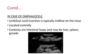 Abdominal wall defects (dr.tanvir) | PPTX