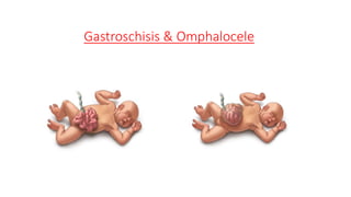 Abdominal wall defects (dr.tanvir) | PPTX