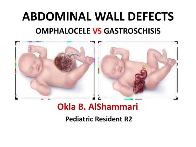 Abdominal wall defects | PPTX