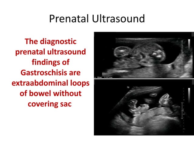 Abdominal wall defects | PPT