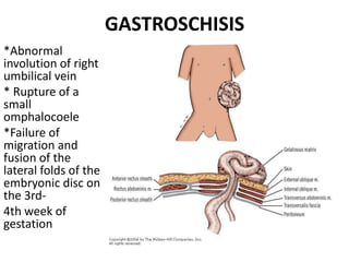 Abdominal wall defects | PPTX
