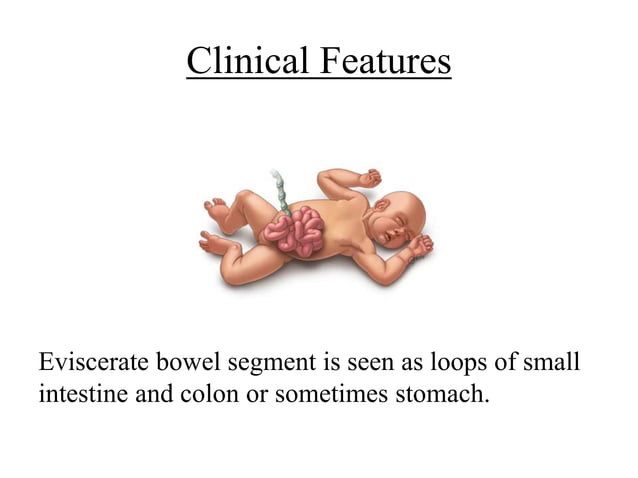 Abdominal wall defects in young children.pptx