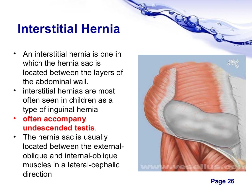 Abdominal wall hernia