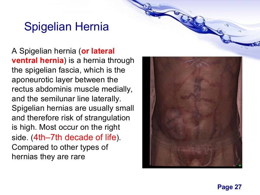Abdominal Wall Hernias