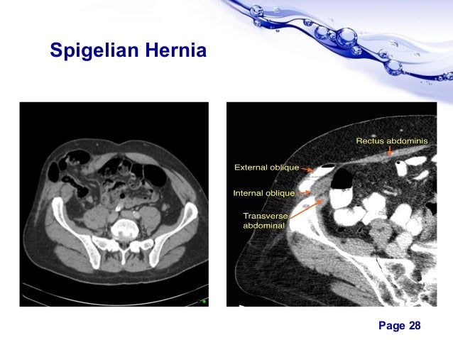 Abdominal wall hernia