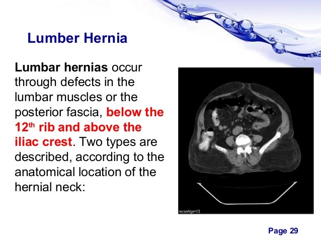 Abdominal wall hernia