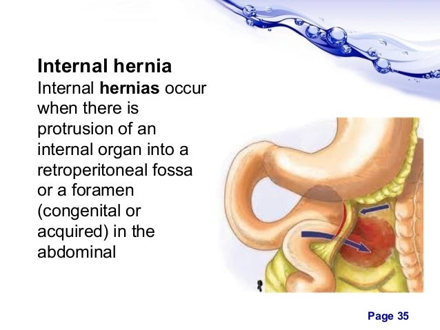 Abdominal wall hernia