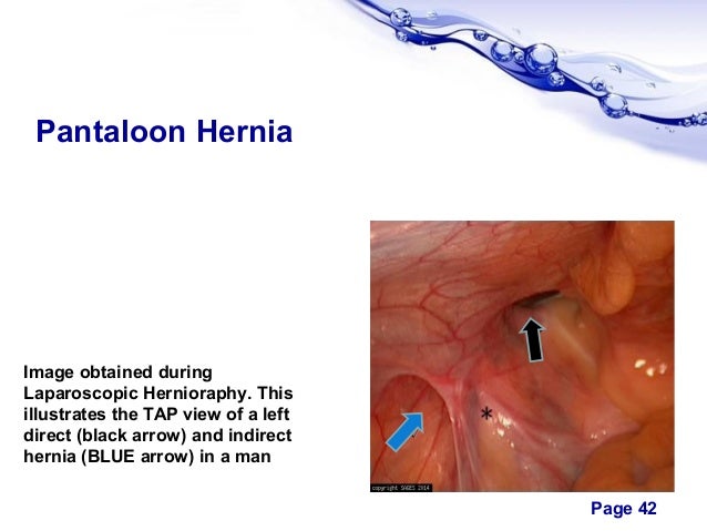 Abdominal wall hernia