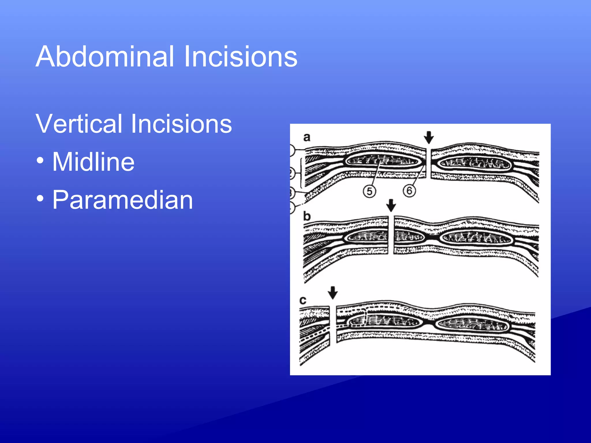 Abdominal wall incision | PPT