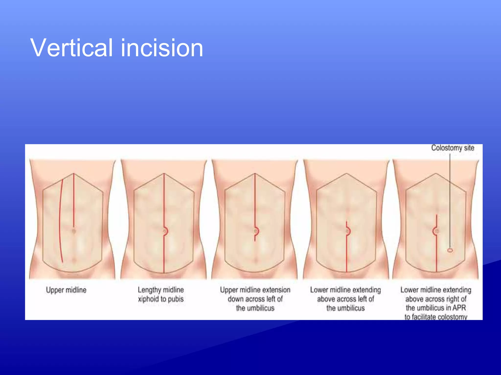 Abdominal wall incision | PPT
