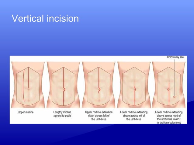 Abdominal wall incision