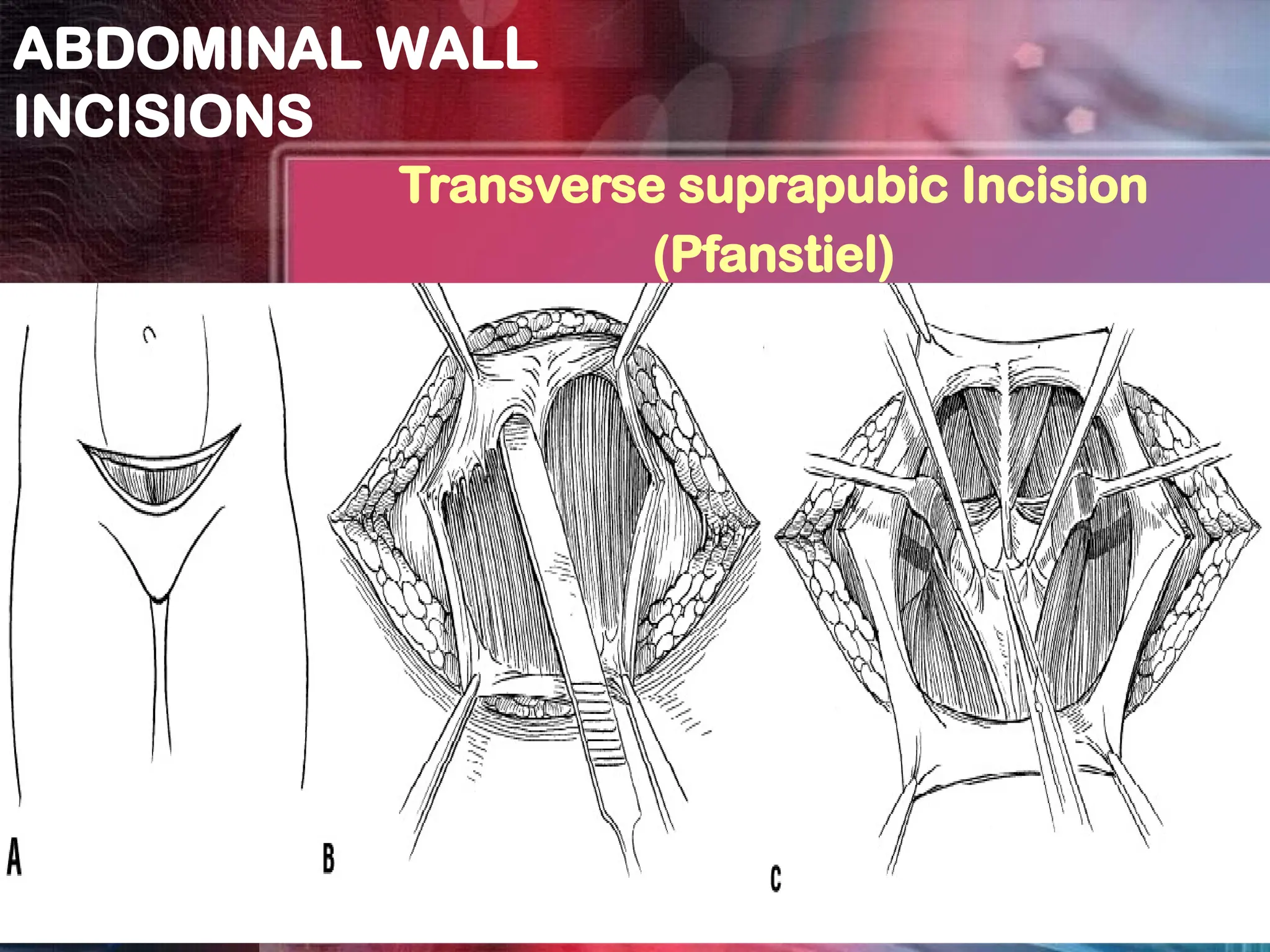 Abdominal wall incisions and Umbilicus.pptx