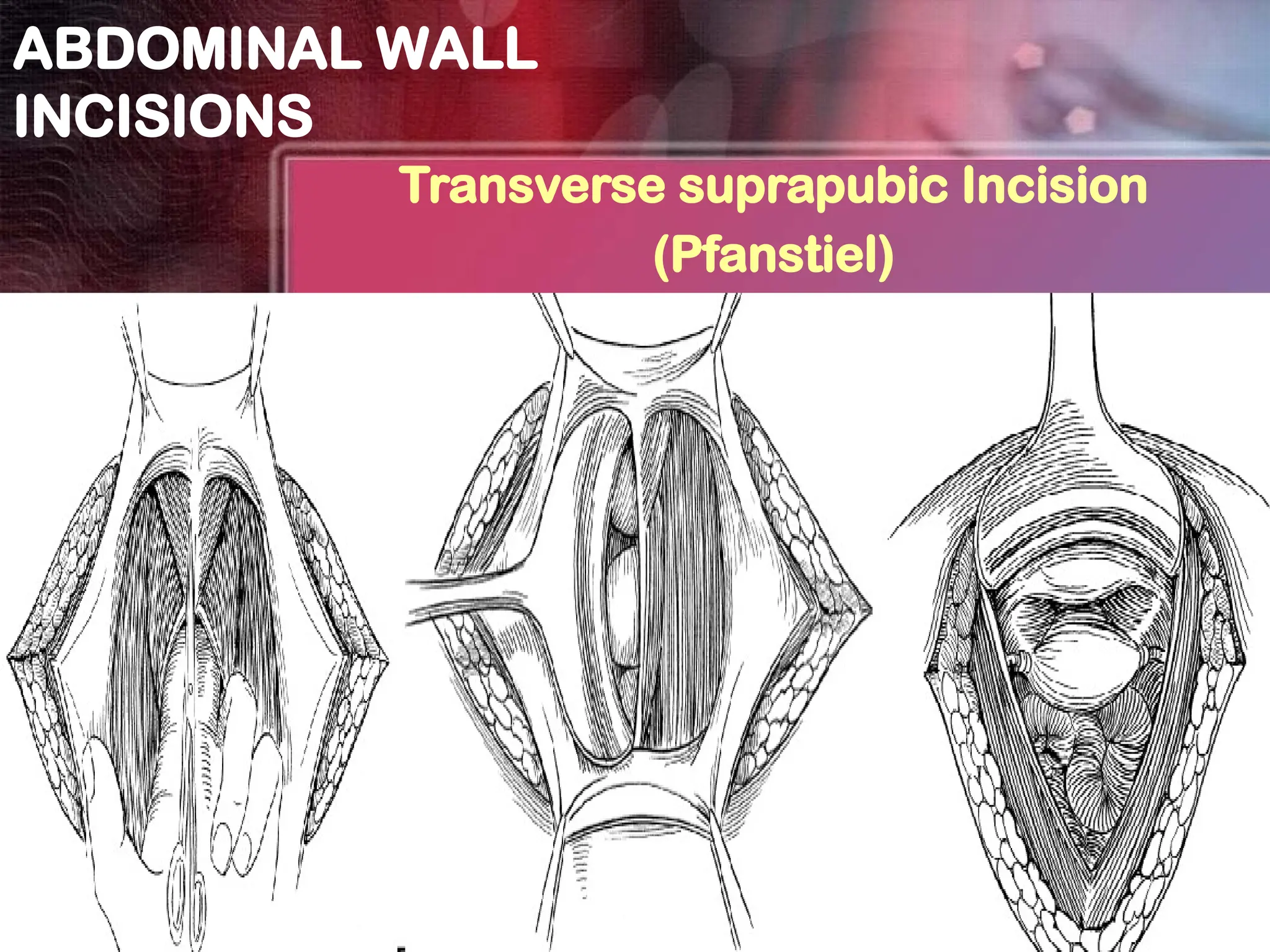 Abdominal wall incisions and Umbilicus.pptx
