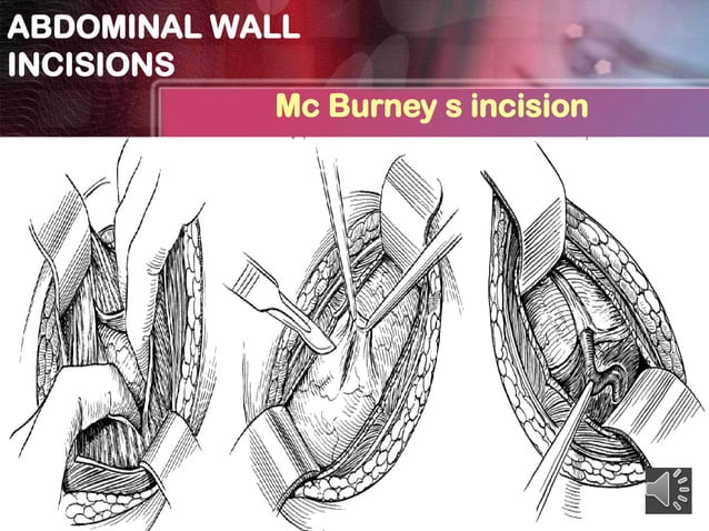Abdominal wall incisions and Umbilicus (2).pptx