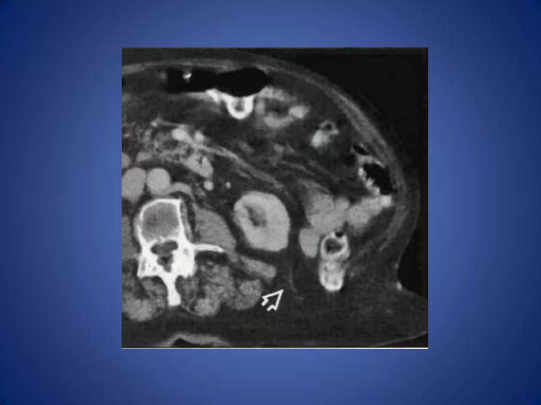 Abdominal wall mass | PPT
