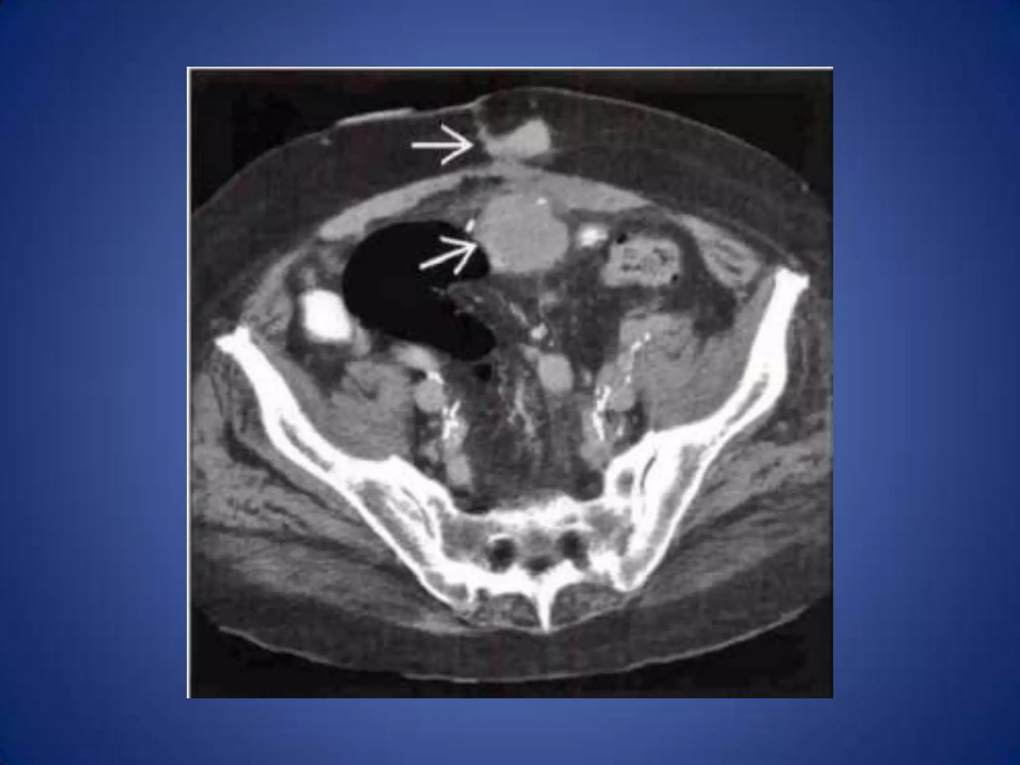 Abdominal wall mass | PPT