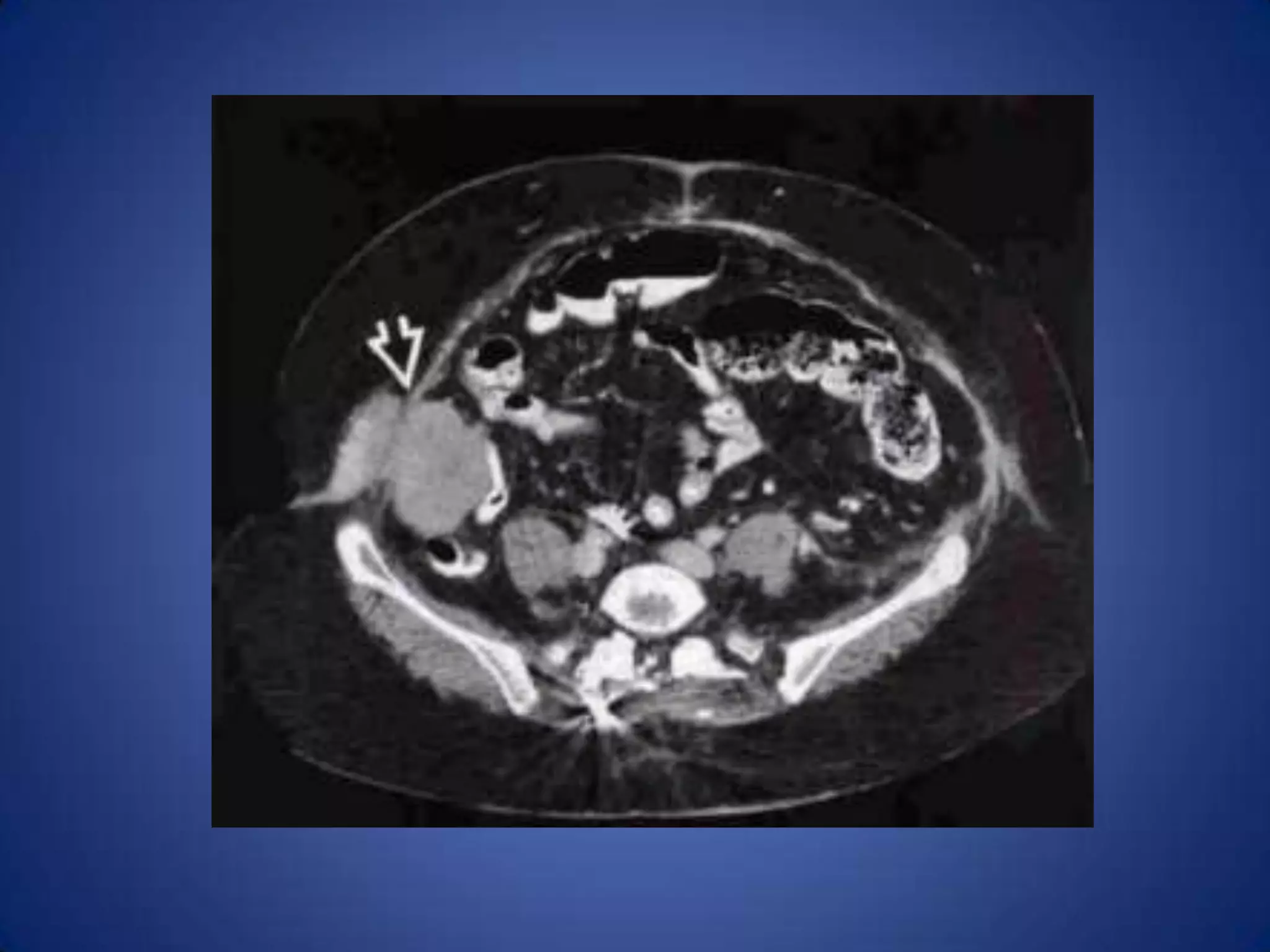 Abdominal wall mass | PPT