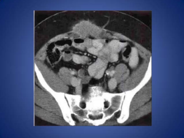 Abdominal wall mass | PPT