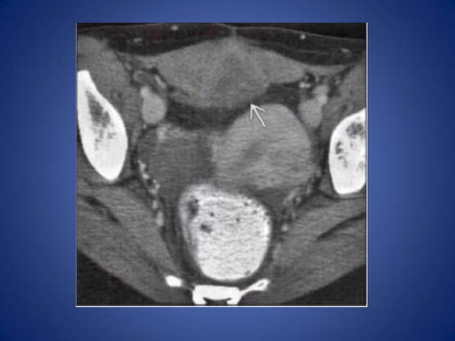 Abdominal wall mass | PPT