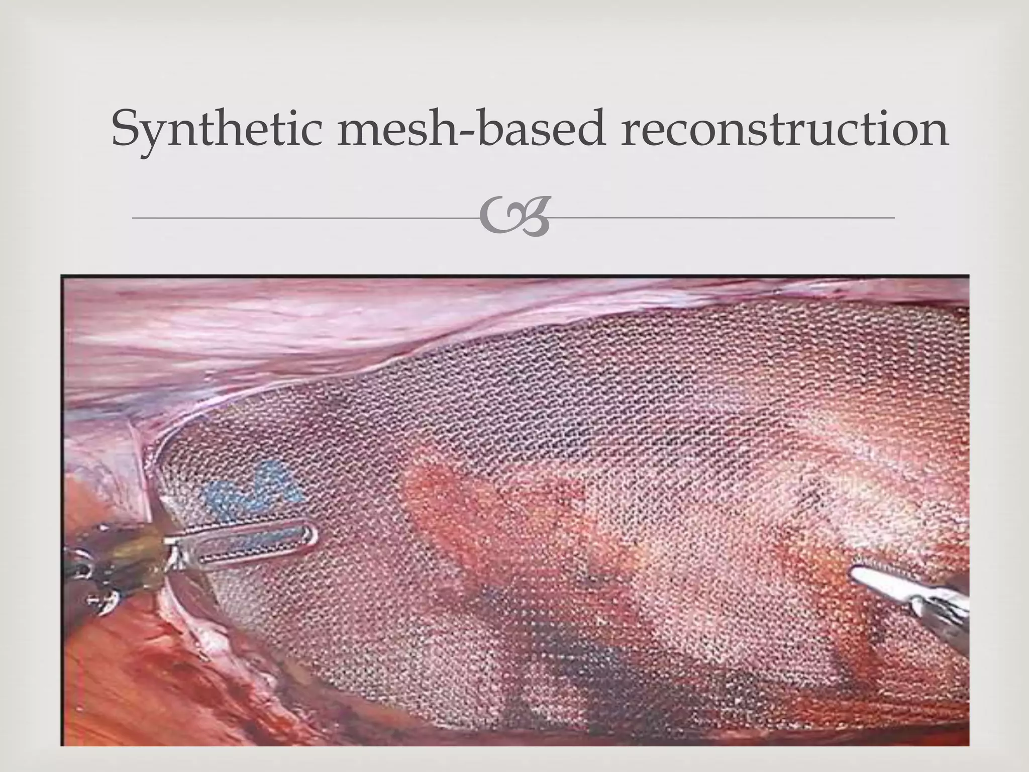 Abdominal wall Reconstruction.pptx