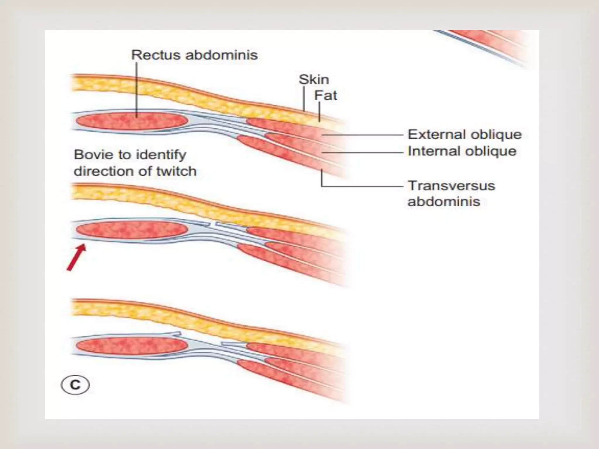 Abdominal wall Reconstruction.pptx