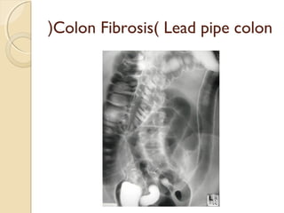 Abdominal x ray | PPT | Digestive Disorders | Diseases and Conditions