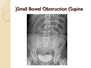 Abdominal x ray | PPT