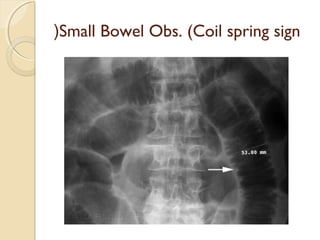 Abdominal x ray | PPT | Digestive Disorders | Diseases and Conditions