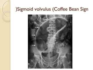 Abdominal x ray | PPT | Digestive Disorders | Diseases and Conditions
