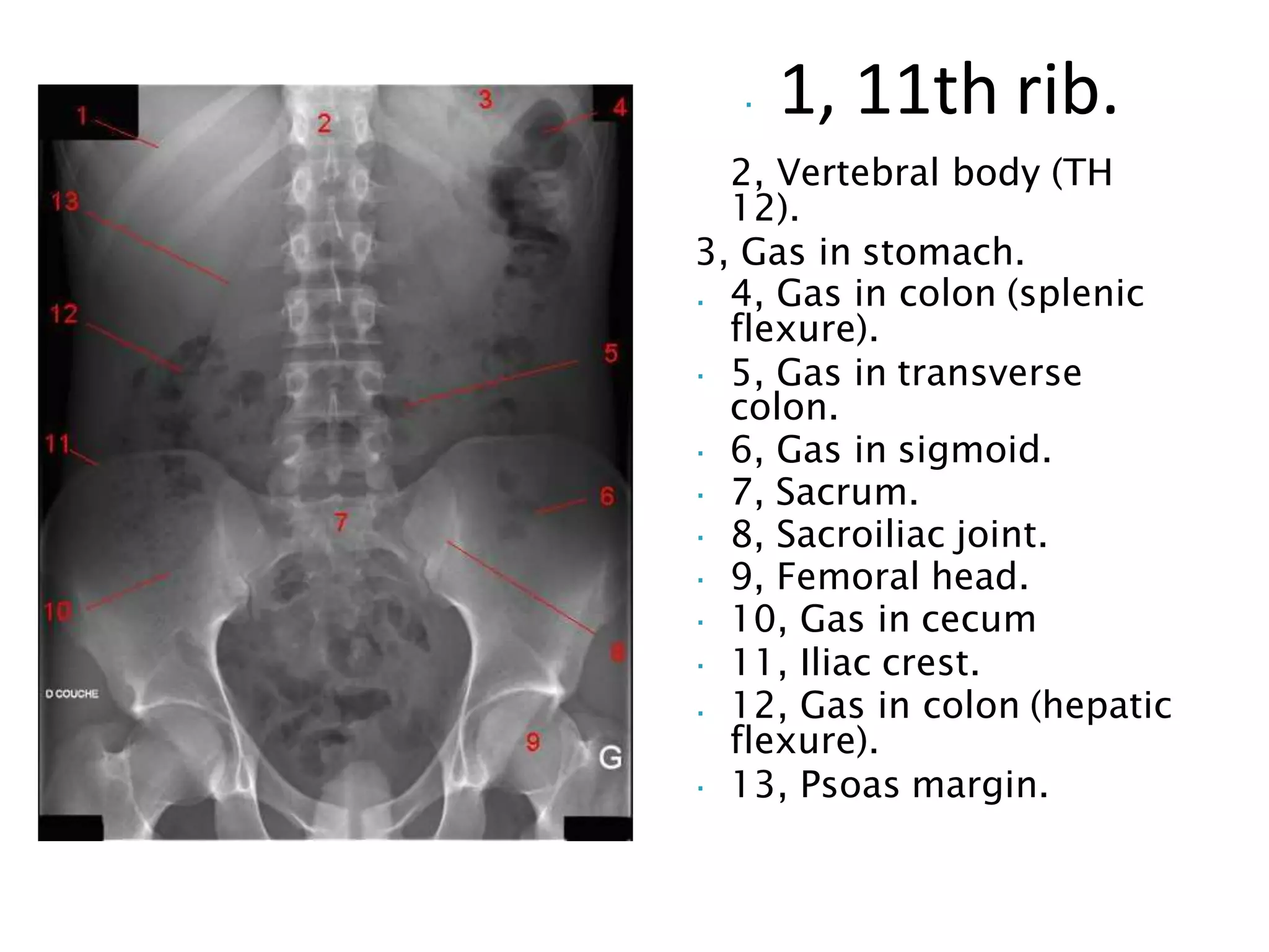 Abdominal x ray | PPTX