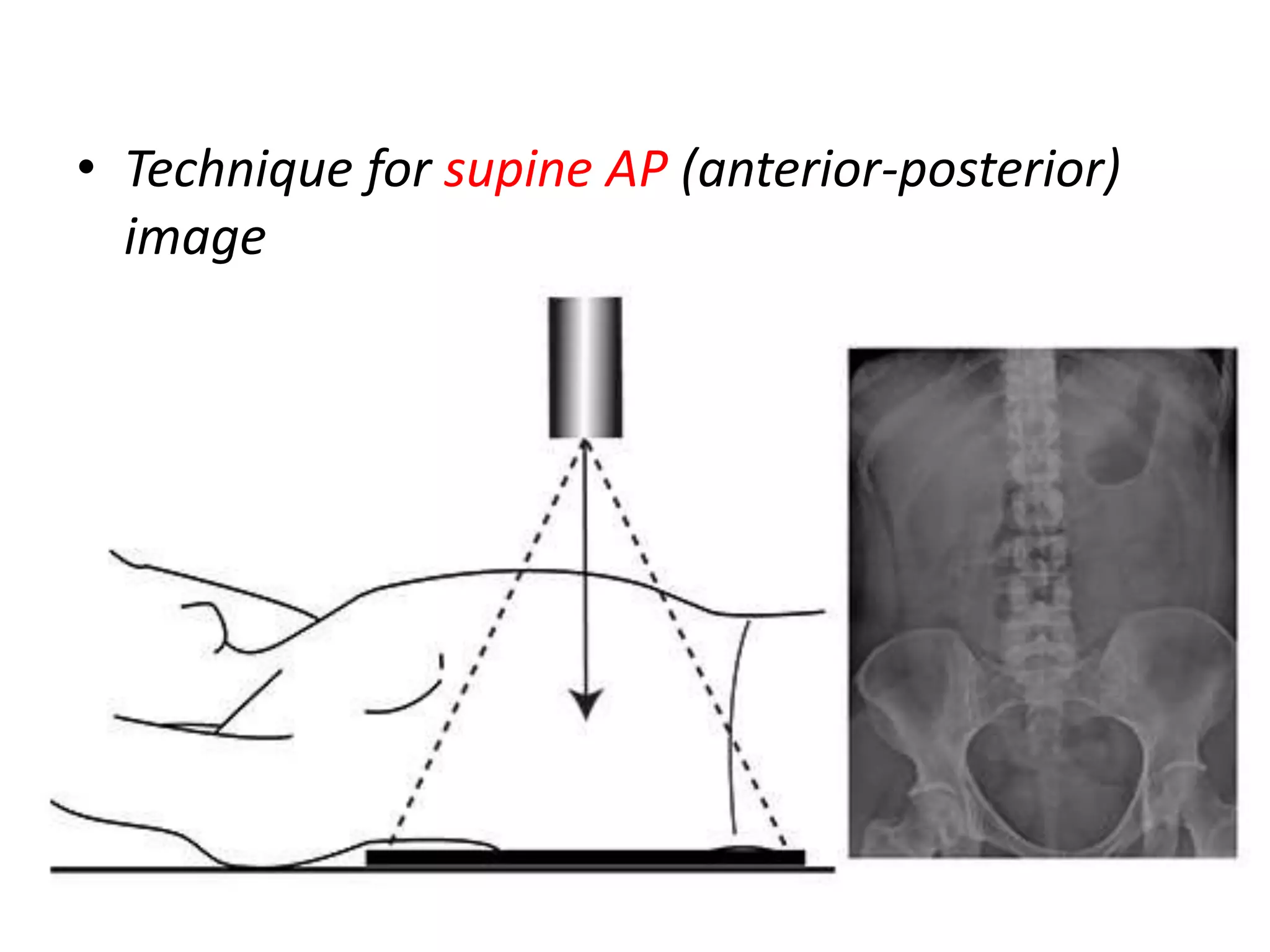 Abdominal x ray | PPTX