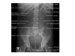 Abdominal x ray | PPTX