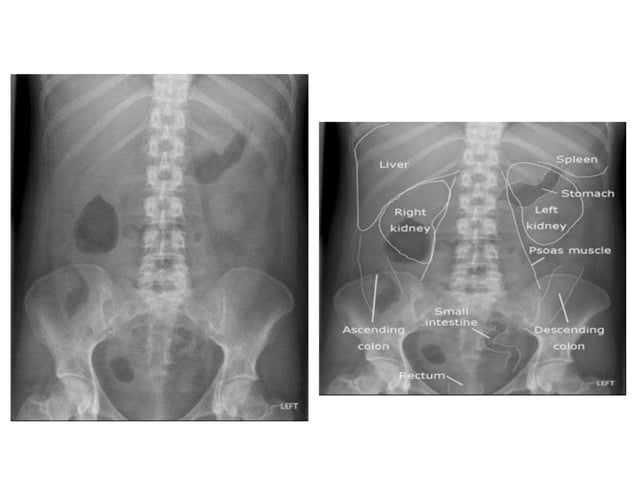 Abdominal x ray | PPTX | Digestive Disorders | Diseases and Conditions