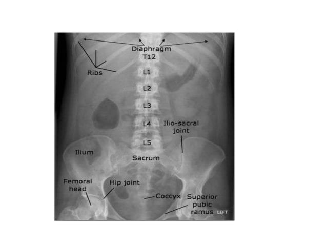 Abdominal x ray | PPTX | Digestive Disorders | Diseases and Conditions