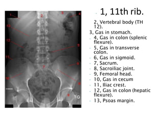 Labeled Abdominal X Ray